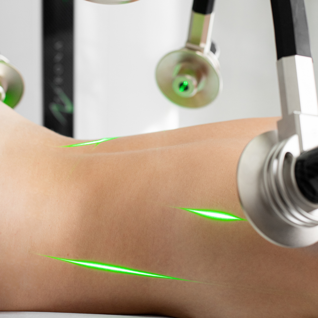 Stretch Marks Treatment | Your #1 Choice For A Radiant Skin